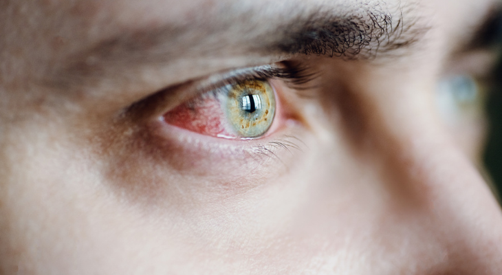 June Newsletter: What Causes Red Eyes and How Can Your Optometrist Help ...
