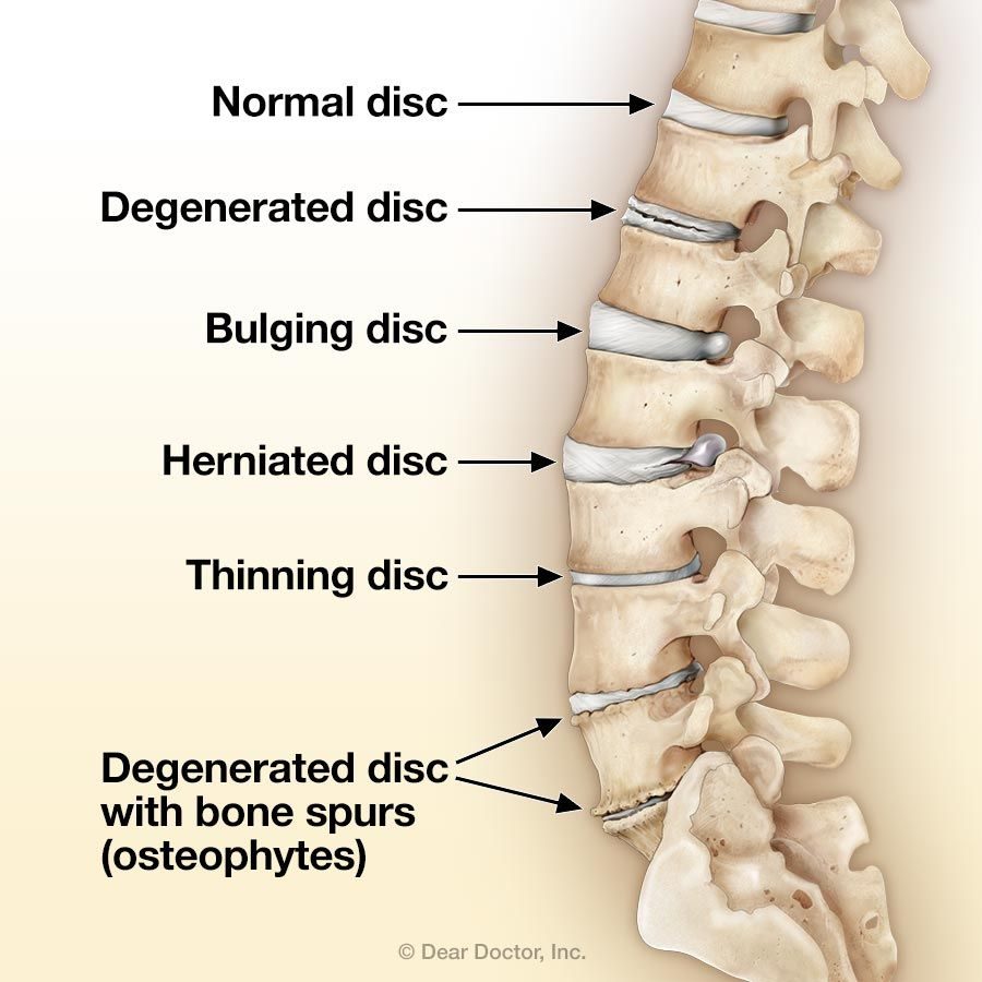 Degenerative Disc Disease Chiropractor In St Augustine, FL | Derek ...