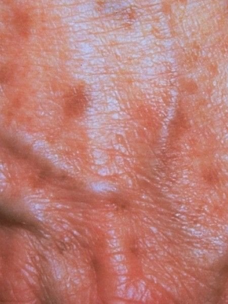 Mature Skin - Dermatologist in East Windsor, NJ | Windsor Dermatology