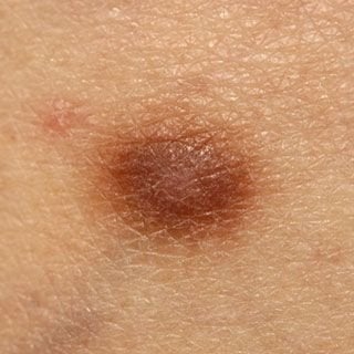 Dermatofibromas - Idaho Dermatology Mohs Collective | Dermatologist in ...