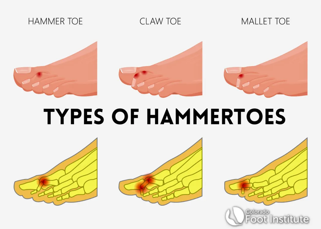 claw toe or hammer toe
