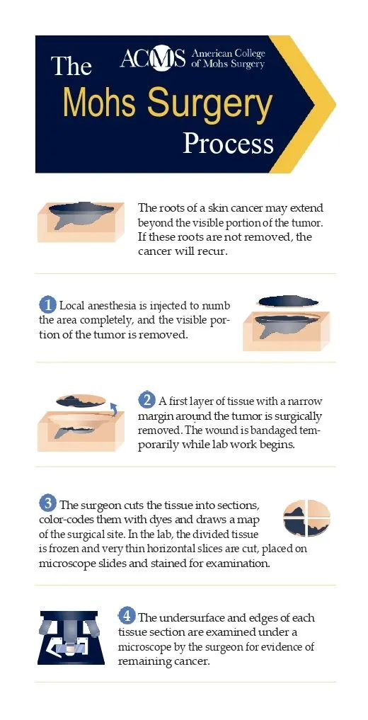 Mohs Micrographic Surgery | Dermatologist Serving IN Areas ...