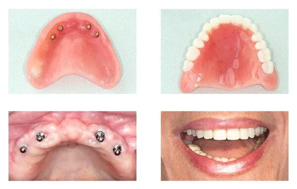 options for upper dentures