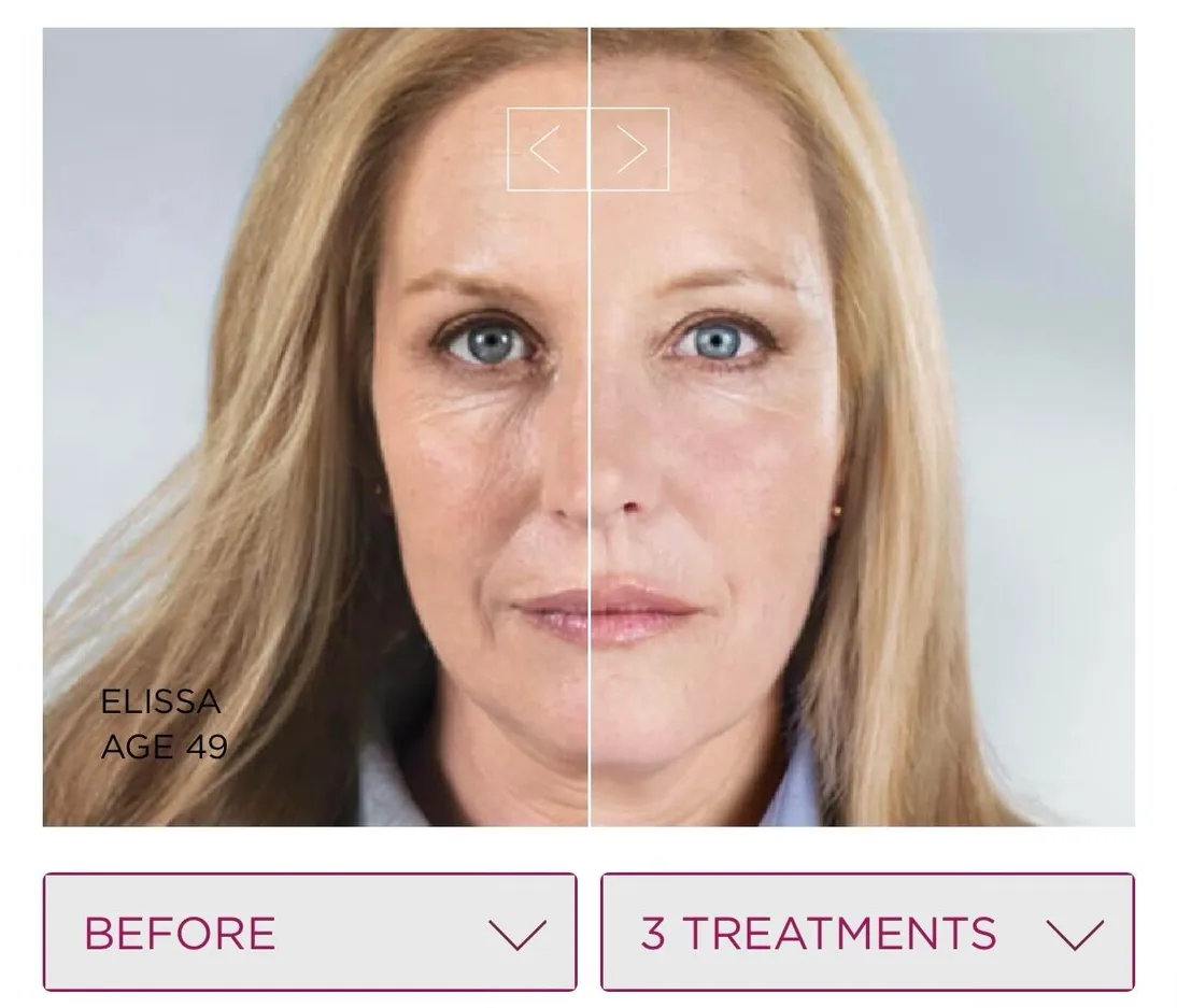 Sculptra at Coastal Derm Medispa- Rhode Island