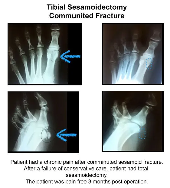 Sesamoid - Robert Sheinberg, DPM | Weston, FL Podiatrist