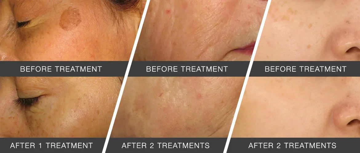 PicoWay Resolve | Med Spa In Tulsa, OK | Tulsa Hills Cosmetic and Laser ...