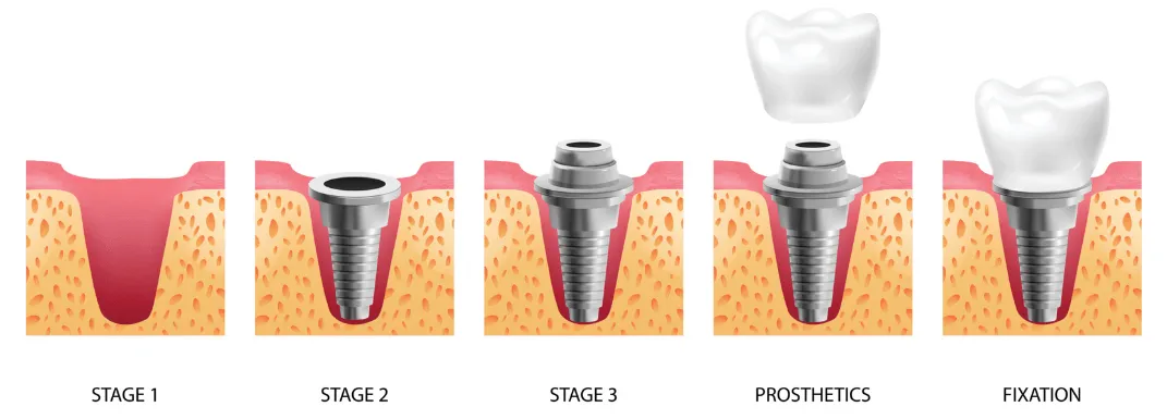 Single Dental Implant - Michigan Periodontics And Implants