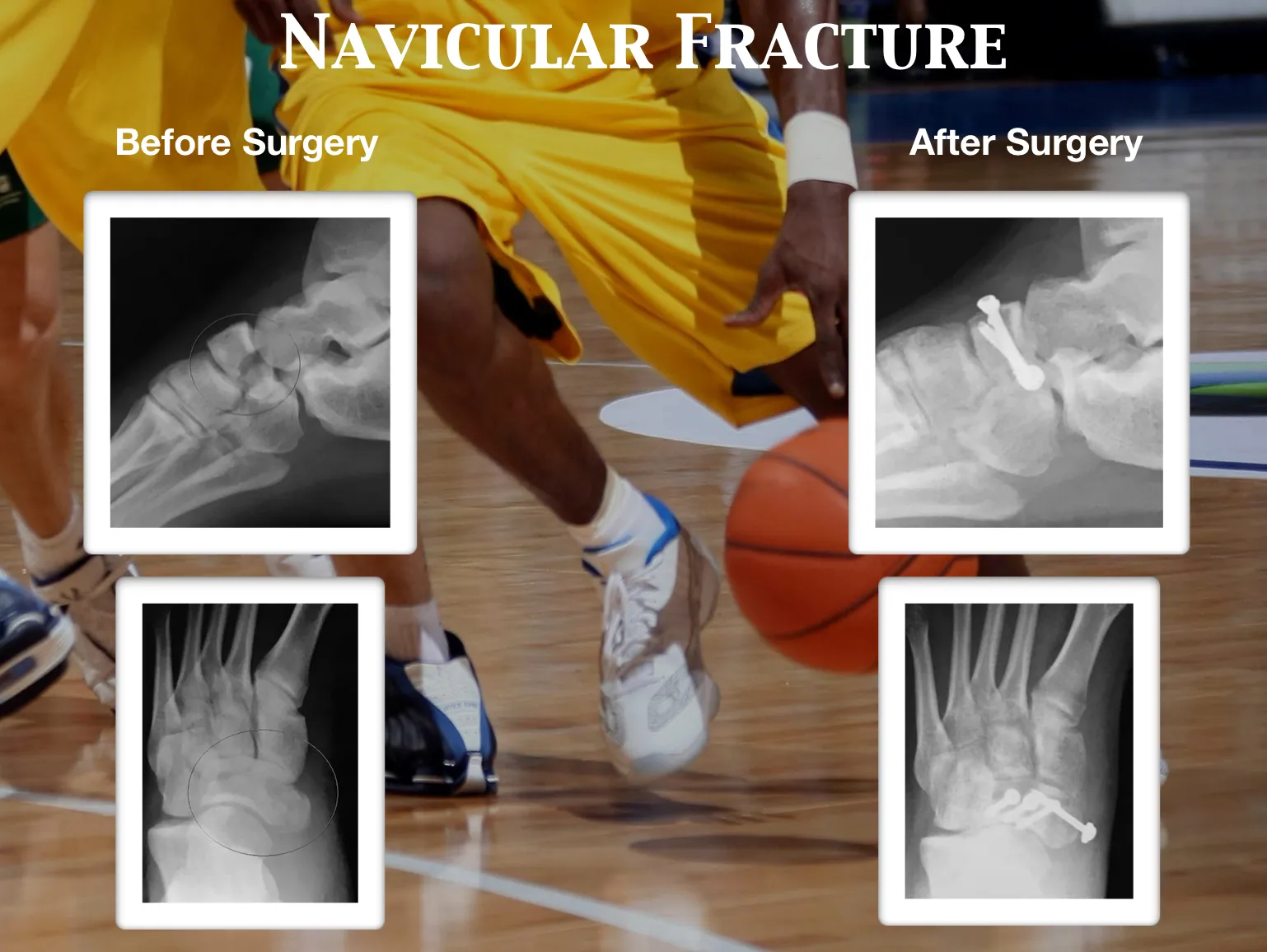 Navicular - Robert Sheinberg, DPM | Weston, FL Podiatrist
