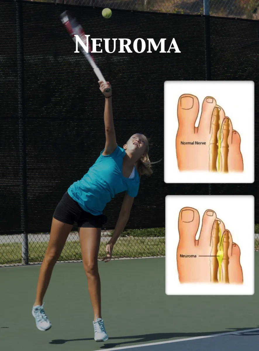 Neuroma - Robert Sheinberg, DPM | Weston, FL Podiatrist