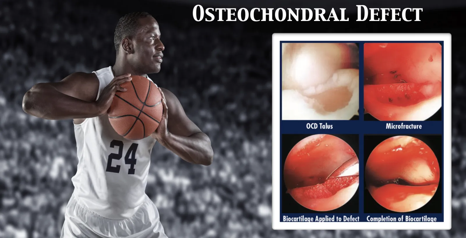 Osteochondral Fracture - Robert Sheinberg, DPM | Weston, FL Podiatrist