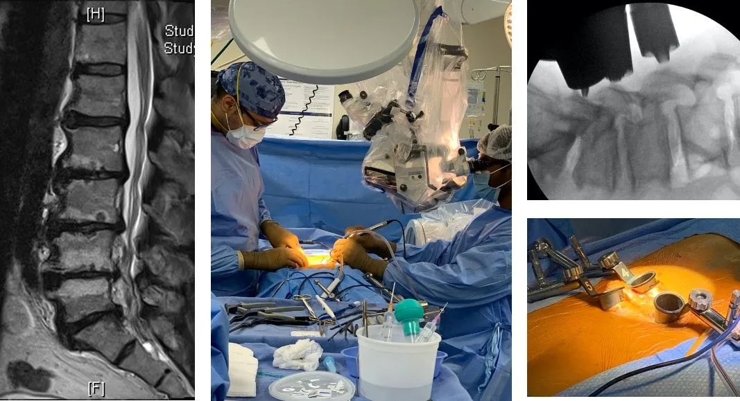 Minimally Invasive Spine Surgery | Neurosurgeon In Milford, CT | Vijay ...