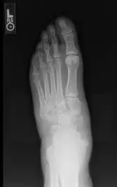 Charcot Neuroarthropathy - Robert Sheinberg, DPM | Weston, FL Podiatrist