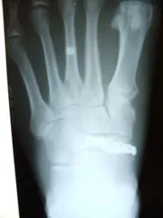 Navicular Fracture - Robert Sheinberg, DPM | Weston, FL Podiatrist