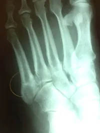 Jones Fracture - Robert Sheinberg, DPM | Weston, FL Podiatrist