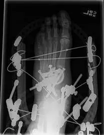 Charcot Neuroarthropathy - Robert Sheinberg, DPM | Weston, FL Podiatrist