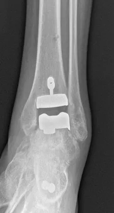 Total Ankle Replacement - Robert Sheinberg, DPM | Weston, FL Podiatrist