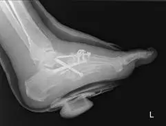 Charcot Neuroarthropathy - Robert Sheinberg, DPM | Weston, FL Podiatrist