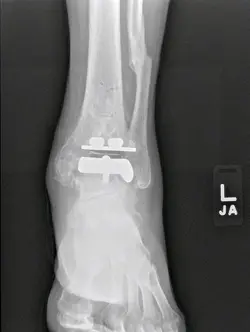 Total Ankle Replacement - Robert Sheinberg, DPM | Weston, FL Podiatrist