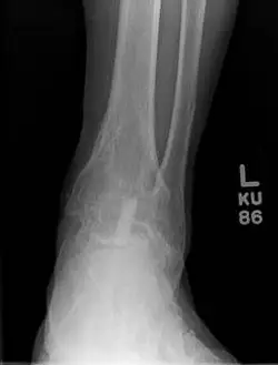 Navicular Body - Robert Sheinberg, DPM | Weston, FL Podiatrist