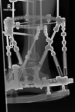 Pilon Fractures - Robert Sheinberg, DPM | Weston, FL Podiatrist