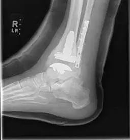 Total Ankle Replacement - Robert Sheinberg, DPM | Weston, FL Podiatrist