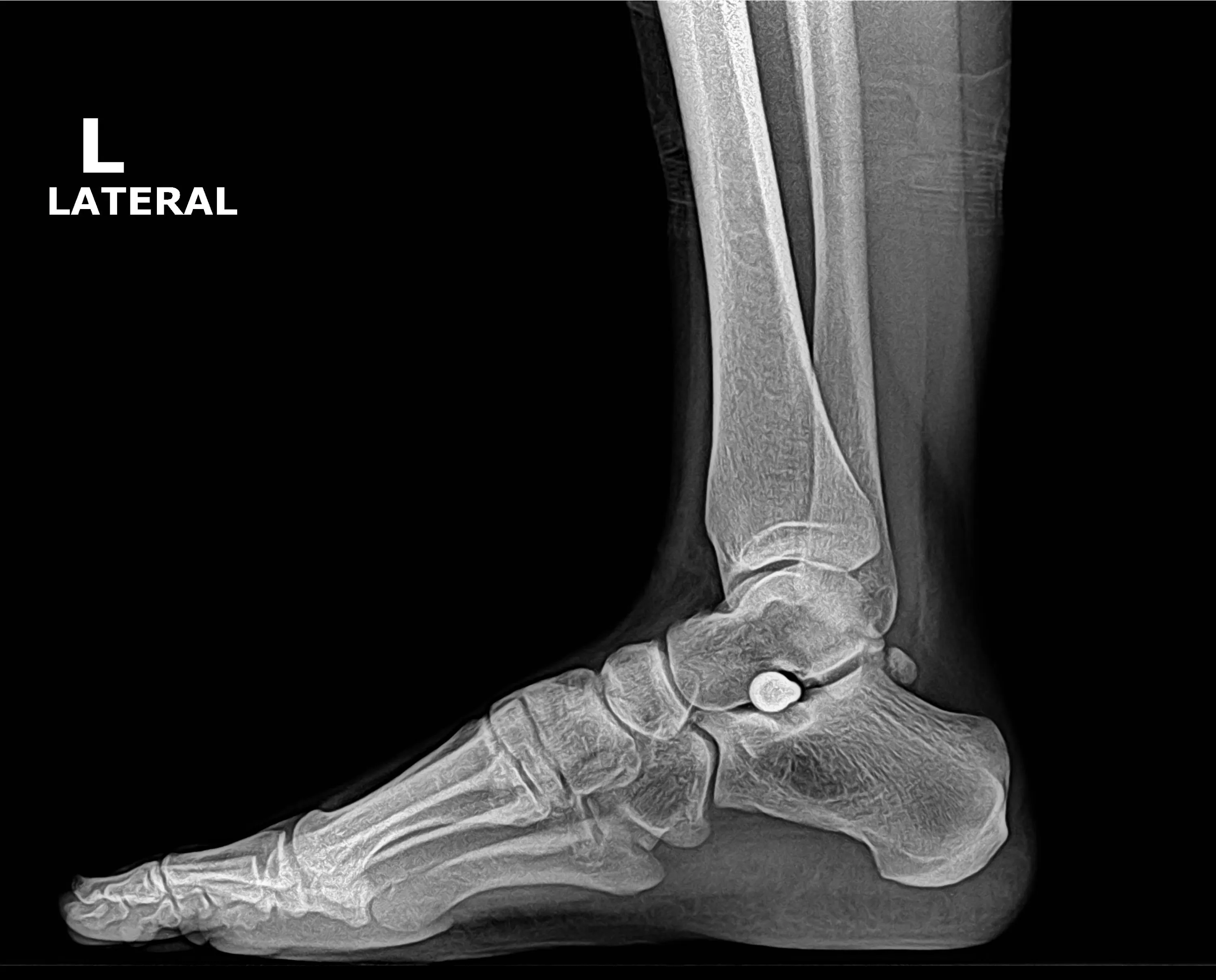 Hyprocure-Flat Feet-Master Surgeon