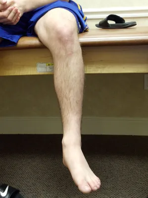 External Tibial Torsion - Robert Sheinberg, DPM | Weston, FL Podiatrist