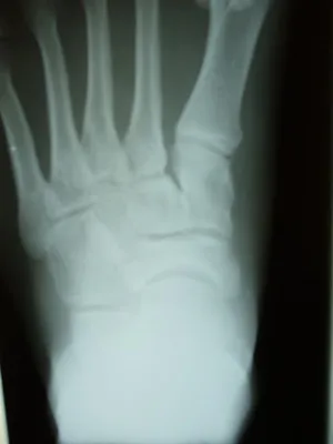 Navicular Fractures - Robert Sheinberg, DPM | Weston, FL Podiatrist