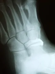 Navicular Fracture - Robert Sheinberg, DPM | Weston, FL Podiatrist