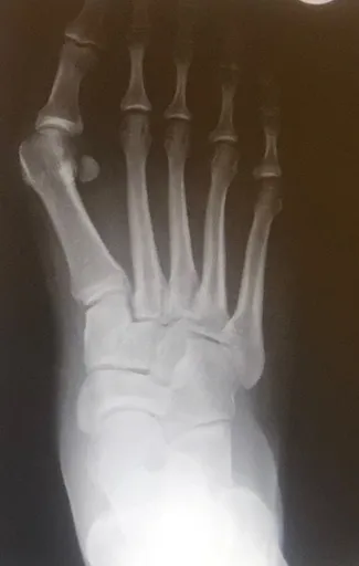 Subtalar Implant + Calcaneal Osteotomy + 1st Metatarsal-Cunieform ...