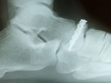 Navicular Stress - Robert Sheinberg, DPM | Weston, FL Podiatrist