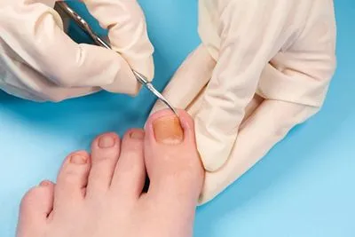 Ingrown Toenail Surgery | Podiatrist in Austin TX | Austin Podiatry