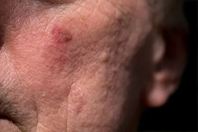 Sun Damage | Dermatologist in Roswell, Alpharetta, Cumming & Sandy ...