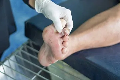 Foot Infection | Podiatrist Serving CT Areas | Connecticut Foot Care ...