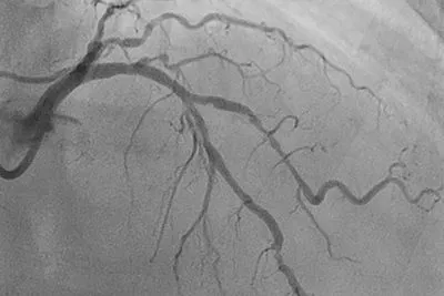Angiogram | Space Coast Vascular | Melbourne & Palm Bay, FL