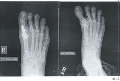 Hallux Varus - Robert Sheinberg, DPM | Weston, FL Podiatrist