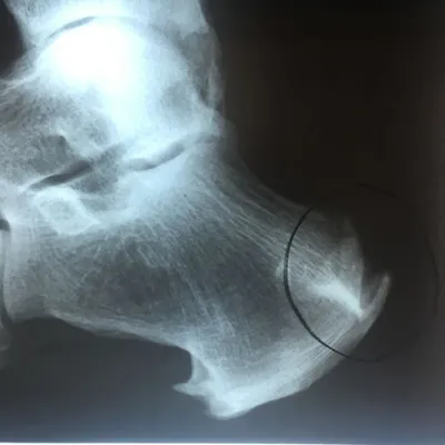 Heel Surgery - Robert Sheinberg, DPM | Weston, FL Podiatrist