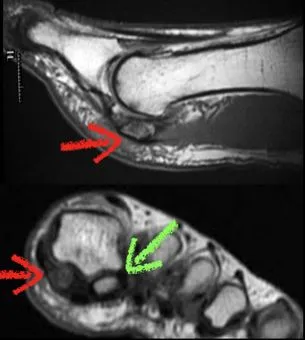 Sesamoid - Robert Sheinberg, DPM | Weston, FL Podiatrist