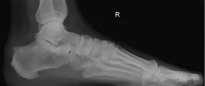 Haglund's Deformity - Robert Sheinberg, DPM | Weston, FL Podiatrist