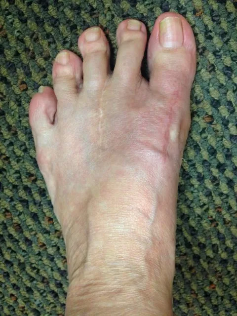 Adult Bunion - Robert Sheinberg, DPM | Weston, FL Podiatrist