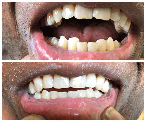 Smile Gallery | Before and After Dental Photos - Smile Makeovers ...
