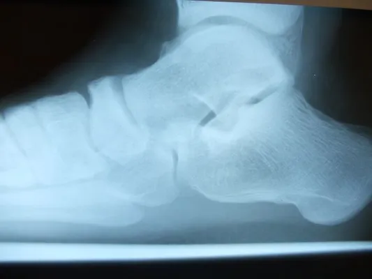 Navicular - Robert Sheinberg, DPM | Weston, FL Podiatrist