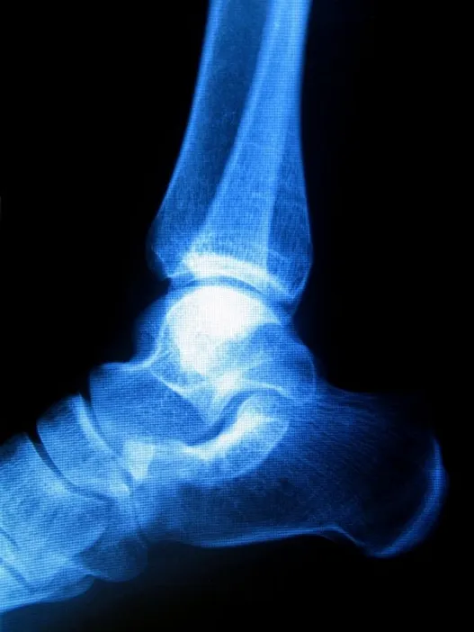 Haglund's Deformity in Greenwood | Warnock Foot & Ankle Center