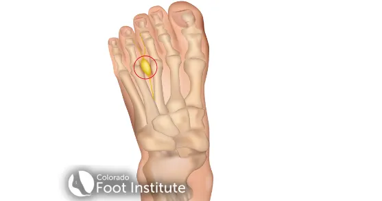 Mortons Neuroma | Like Walking on a Pea | Causes of Foot Pain
