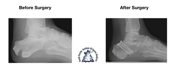 Calcaneal Fractures - Robert Sheinberg, DPM | Weston, FL Podiatrist