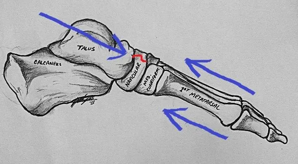 Navicular Stress - Robert Sheinberg, DPM | Weston, FL Podiatrist