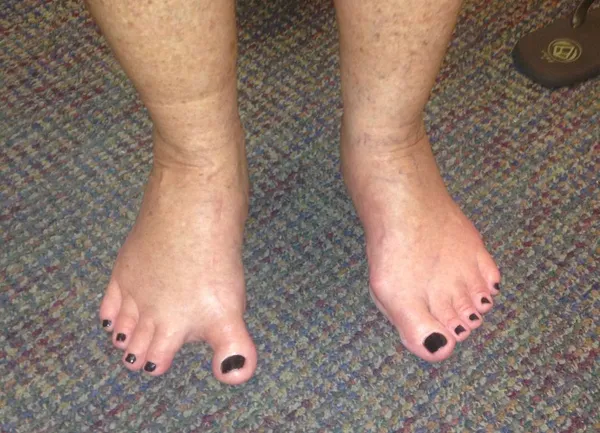 Hallux Varus - Robert Sheinberg, DPM | Weston, FL Podiatrist