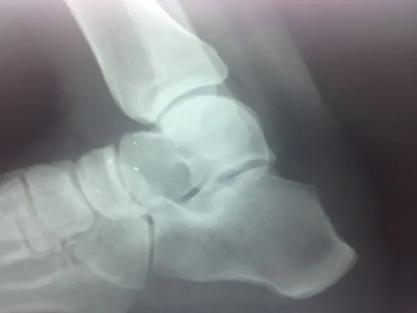 Achilles Spur - Robert Sheinberg, DPM | Weston, FL Podiatrist