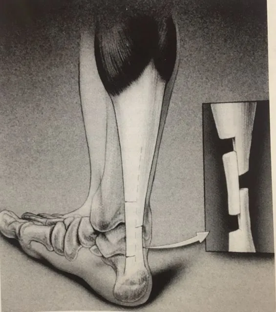 Flat Feet - Robert Sheinberg, DPM | Weston, FL Podiatrist