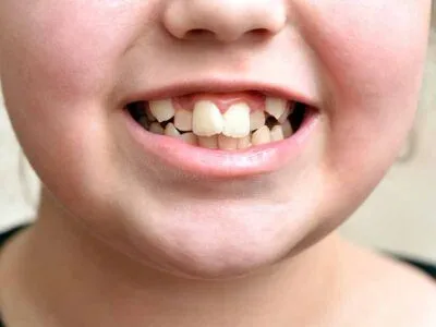 Dentist4 | Misaligned Teeth in Pompano Beach